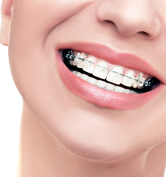 Orthodontic Dentistry | The Ross Dental Esthetique